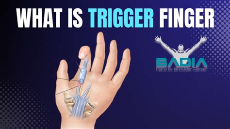 What is Trigger Finger? - DrBadia.com