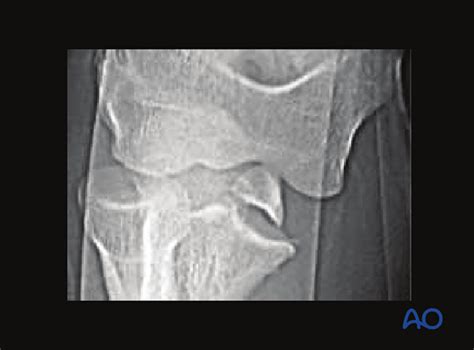 Avulsion Of Medial Epicondyle