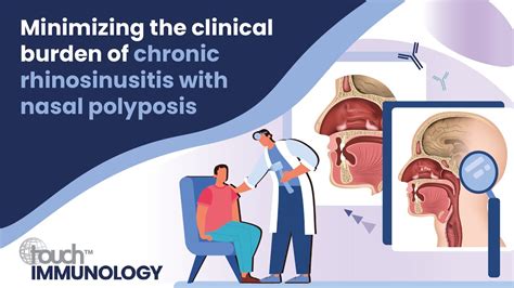 Minimizing The Clinical Burden Of Chronic Rhinosinusitis With Nasal