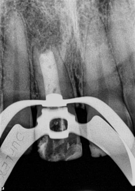 Case Report Use Of Bio C Repair A Bioceramic Based Cement In The