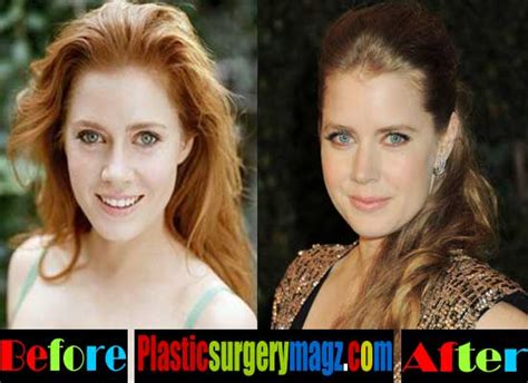 Amy Adams Plastic Surgery Before And After Pictures Plastic Surgery