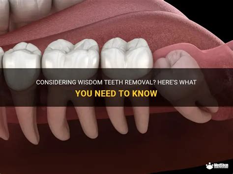Considering Wisdom Teeth Removal Heres What You Need To Know Medshun