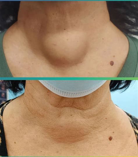 Marco Zaccaria On Linkedin Thyroid Saveyourthyroid