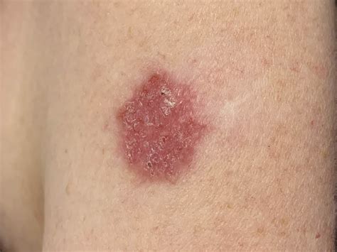 Superficial Bcc Early Skin Cancer And Non Surgical Treatment