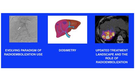 Radioembolization For Hepatocellular Carcinoma Updated Strategies And