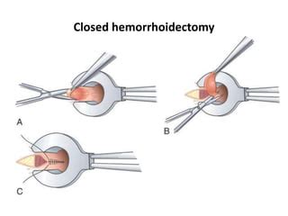 Haemorrhoids Gd District Hospital Nashikppt