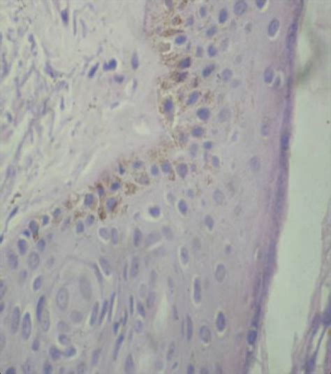 Imatinib Induced Melasma Like Pigmentation Report Of Five Cases And