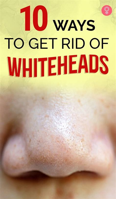10 Ways To Get Rid Of Whiteheads Causes Tips To Prevent It Artofit