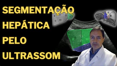 Aprenda De Uma Vez A Segmentação Hepática Pelo Ultrassom Youtube