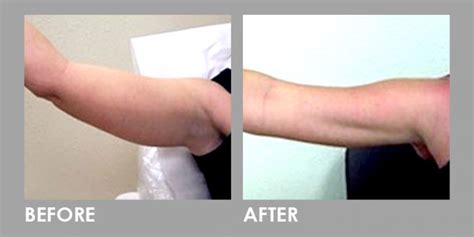 Mesolipo Fat Melting Slimming Injections Premier Clinic