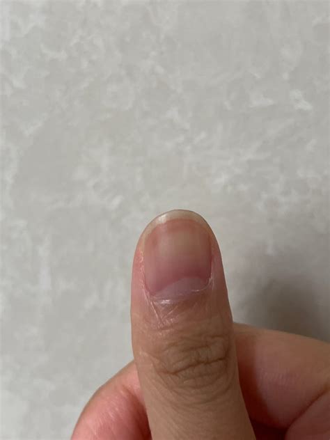 엄지손톱 세로줄 무슨 뜻인가요 지식in