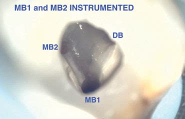 The Notorious Mb2 Canal How To Find And Treat It Oral Health Group