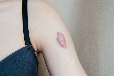 Como Evitar Queloide Aprenda Cuidados Essenciais Para Prevenir Cicatrizes Elevadas