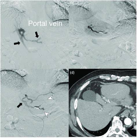 Angiographic Image Demonstrating Embolization In A 68 Year Old Male Download Scientific Diagram