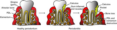 Schematic Diagram Illustrating The Stages Of Periodontitis A Anatomy