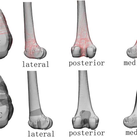 PDF Three Dimensional Fracture Mapping And Analysis Of Coronal Fractures In AO OTA Types B