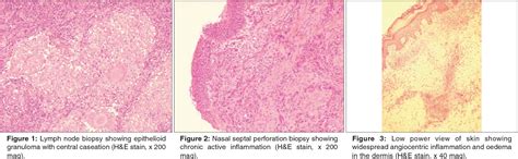 Figure 1 From Tuberculosis With Secondary Vasculitis Presenting As A Nasal Septal Perforation