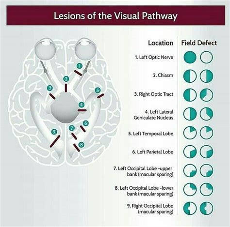 Rapid Revision Of Optic Pathway Lesion Medizzy