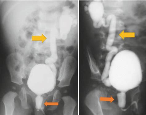 Congenital Megaureter Abdominal Key