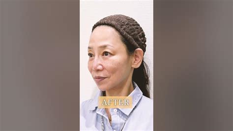 【整形レベルのアンチエイジング】思ってたのと違う！54歳女性の本来の美しさを引き出す｜ヒアルロン酸ビフォーアフター Shorts