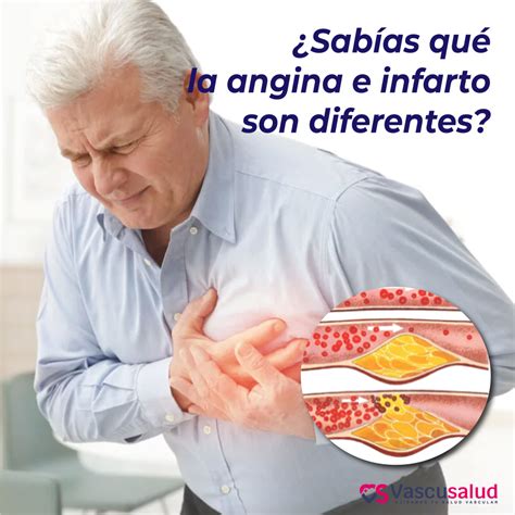 ¿sabías Qué Angina De Pecho E Infarto Son Diferentes