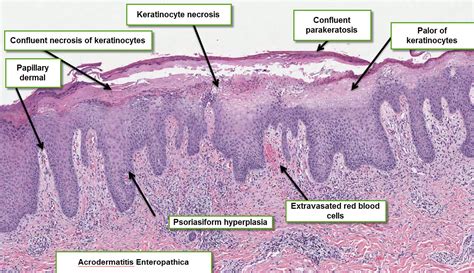 Acrodermatitis Enteropathica Histology