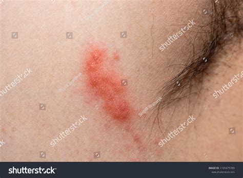 Armpit Blisters