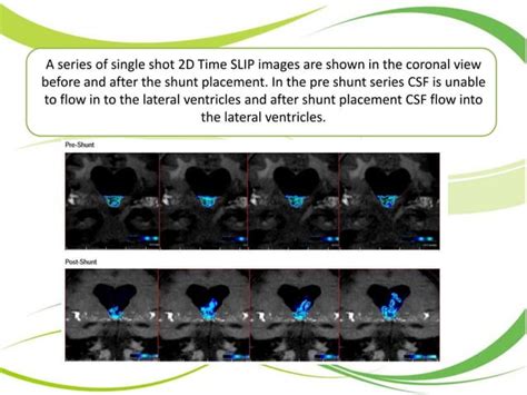 Csf Flow Study PPTX