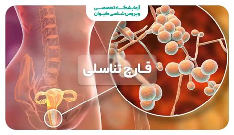 قارچ تناسلی چیست؟ تفاوت قارچ تناسلی و زگیل تناسلی