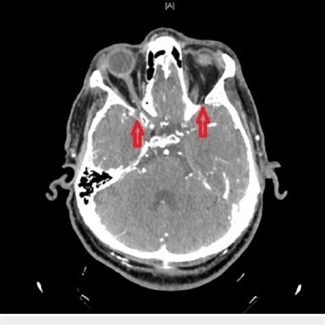 Neck And Head Ct Angiography Showed Bilateral Ica Occlusion Ica