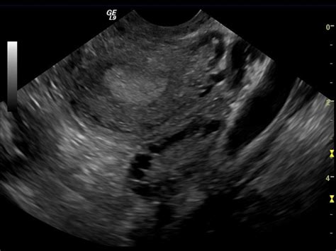 Polycysticovaryultrasound Foundation For Alternative And