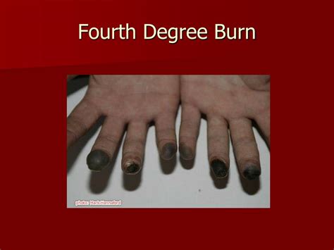 4th Degree Burn Healing Time Burn Wound Healing Stages Chart Ruwq