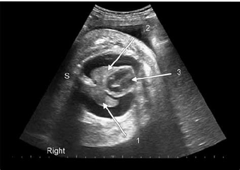 Sonographic Views Of A 33 4 Week Gestation Fetus With A Fetal Hydrops Download Scientific