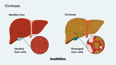 Cirrhosis Causes Symptoms Treatment