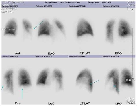 Lung Perfusion Scan Shows A Large Wedge Shaped Perfusion Defect In Left Download Scientific