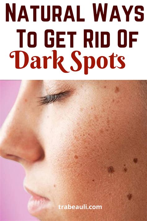 How To Get Rid Of Dark Spots Overnight With Home Remedies Artofit