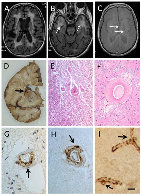 Neuroimaging And Neuropathological Aspects Of Cadasil A C Axial Plane