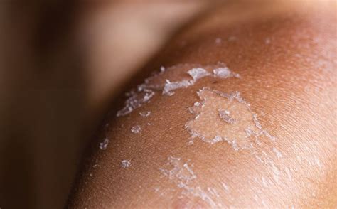 Why Does Sunburned Skin Peel Discover The Science