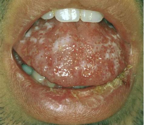Erythema Multiforme European Association Of Oral Medicine