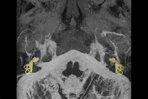 Ai Tool For The Fully Automated Segmentation Of The Inner Ear On News