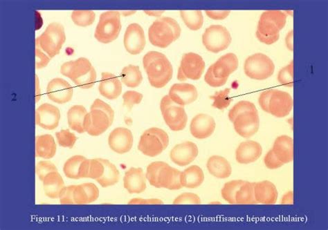 Acanthocytes Et échinocytes Insuffisance Hépatocellulaire La Revue Du Praticien