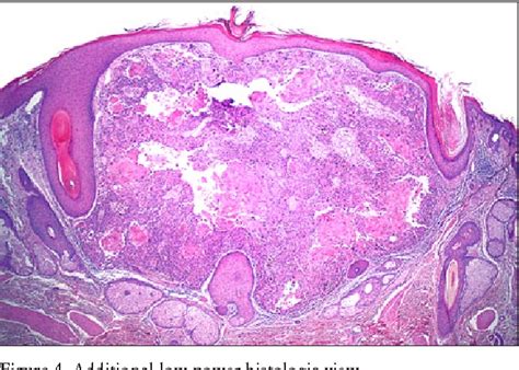 Figure 1 From Cutaneous Pigmented Invasive Squamous Cell Carcinoma A