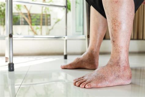 why you shouldn t ignore swelling manjulatha badam md cwsp uhm
