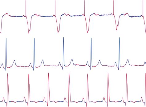 Github Bowang Labecg Fm An Electrocardiogram Analysis Foundation Model