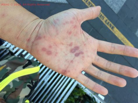 Do You Know How Syphilis Is Passed On Lets Treat Syphilis