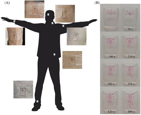 Simultaneous Detection Of Urea And Lactate In Sweat Based On A Wearable Sweat Biosensor Pmc