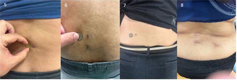 Endoscopic Spine Surgery In Singapore Achieve Spine