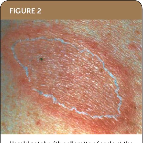 Pityriasis Rosea Herald Patch