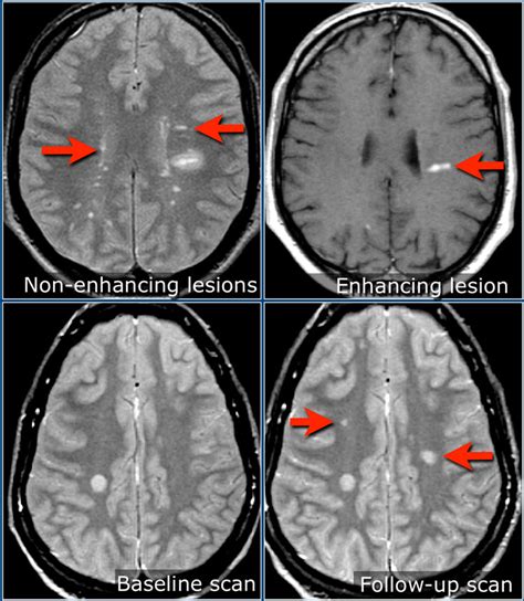 The Radiology Assistant Multiple Sclerosis