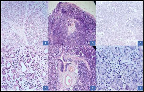 Photomicrograph Of Submandibular Sialadenitis Showing Lobules Of